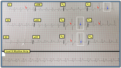 ECG Interpretation: ECG Blog #157 (RBBB - LBBB- WPW - RVH - ST depression)