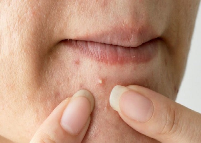 Saiba Tudo Sobre a Acne! - Saúde & Conhecimento