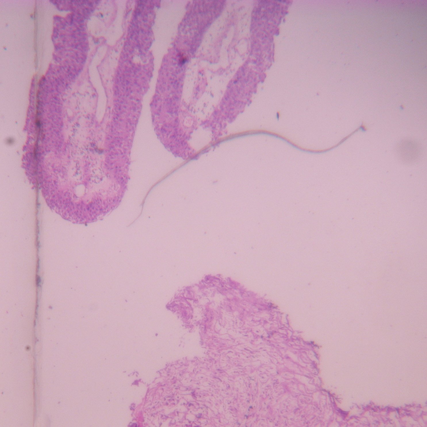 into the roots: Sarcomatoid variant of transitional cell carcinoma