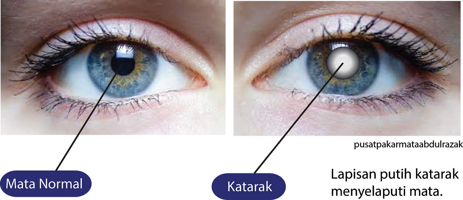 Cara Atasi Masalah Katarak Elak Pembedahan Mata | Never Lose Hope...