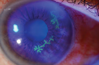 Photos For Herpes Simplex Keratitis (HSK) - Dendritic Corneal Ulcer ...