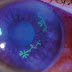 Photos For Herpes Simplex Keratitis (HSK) - Dendritic Corneal Ulcer ...