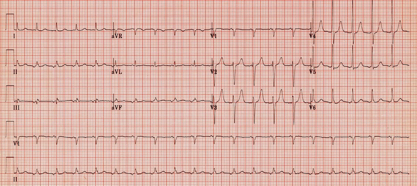Atrial Tachycardia | INA - ECG