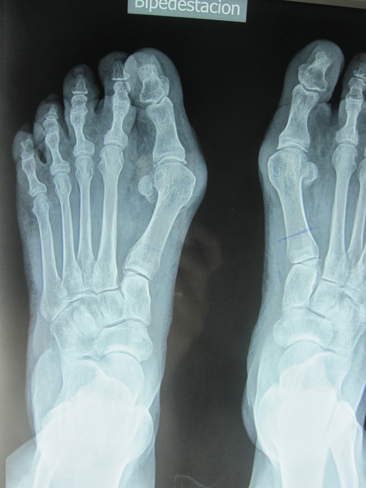 Mortons Neuroma Xray