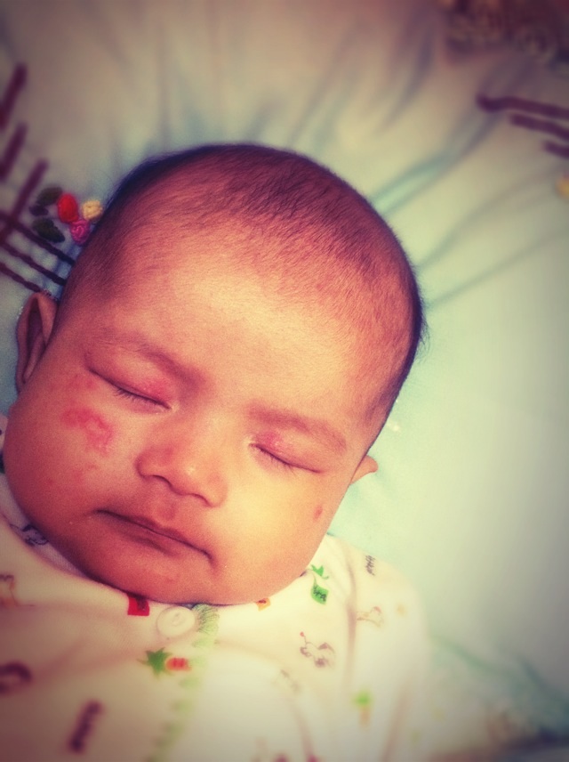 Its all about AinaMiza: Kurap Susu atau Ruam Susu