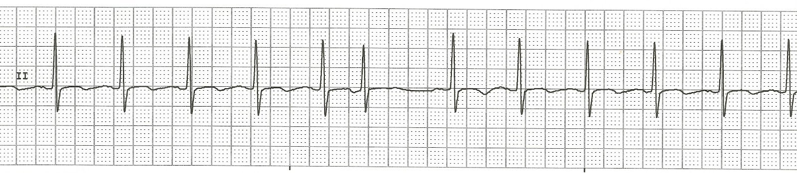 Float Nurse: ECG Rhythm Strips 80