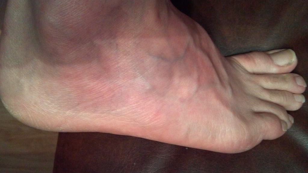 Chris' peroneal tendon surgery: How It All Started