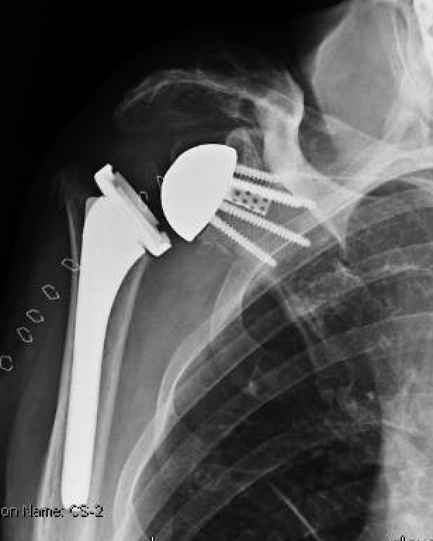 Shoulder and Elbow Surgery: Dislocation of reverse shoulder replacement ...