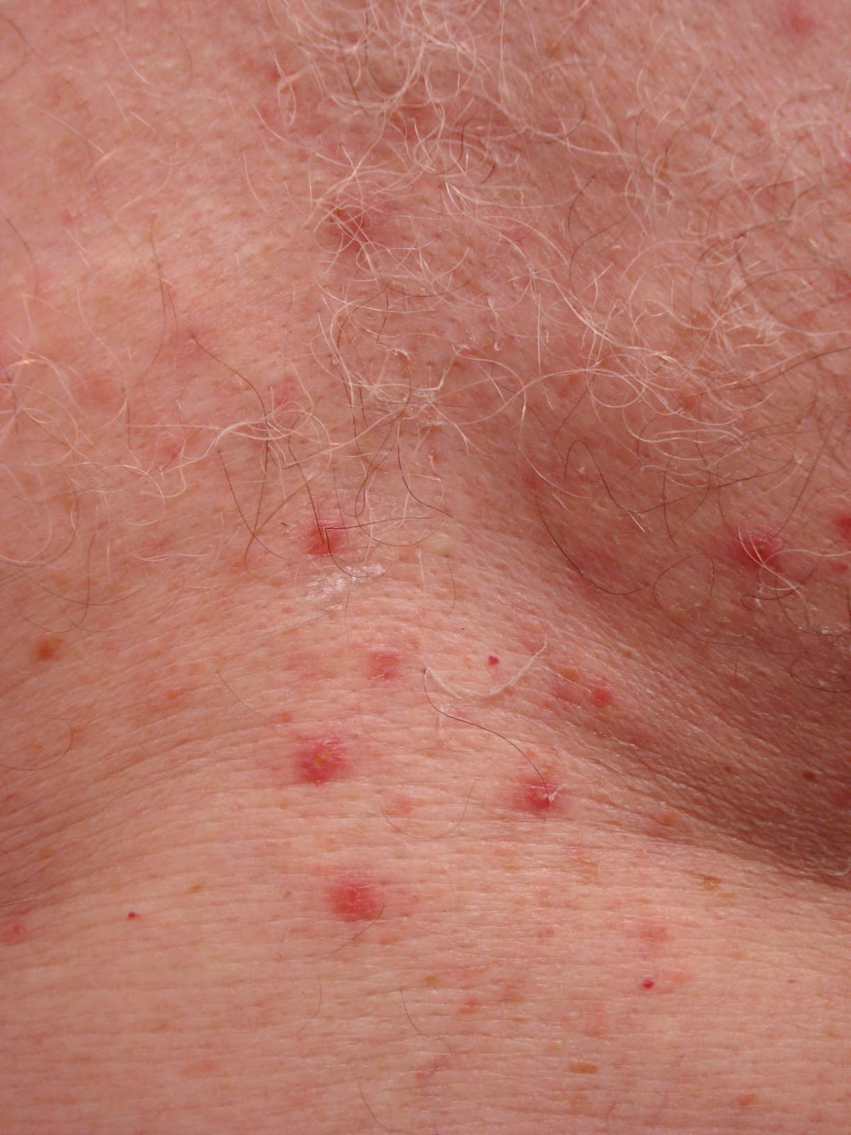 Skin Bump Disease