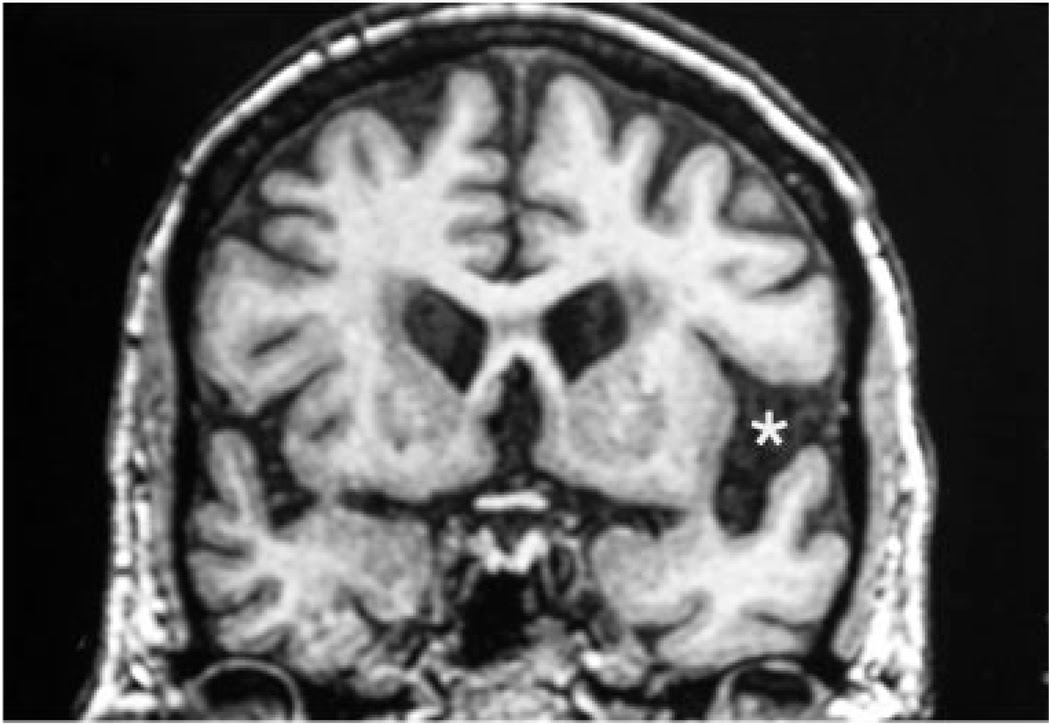 MedNuvem: Afasia Progressiva Primária