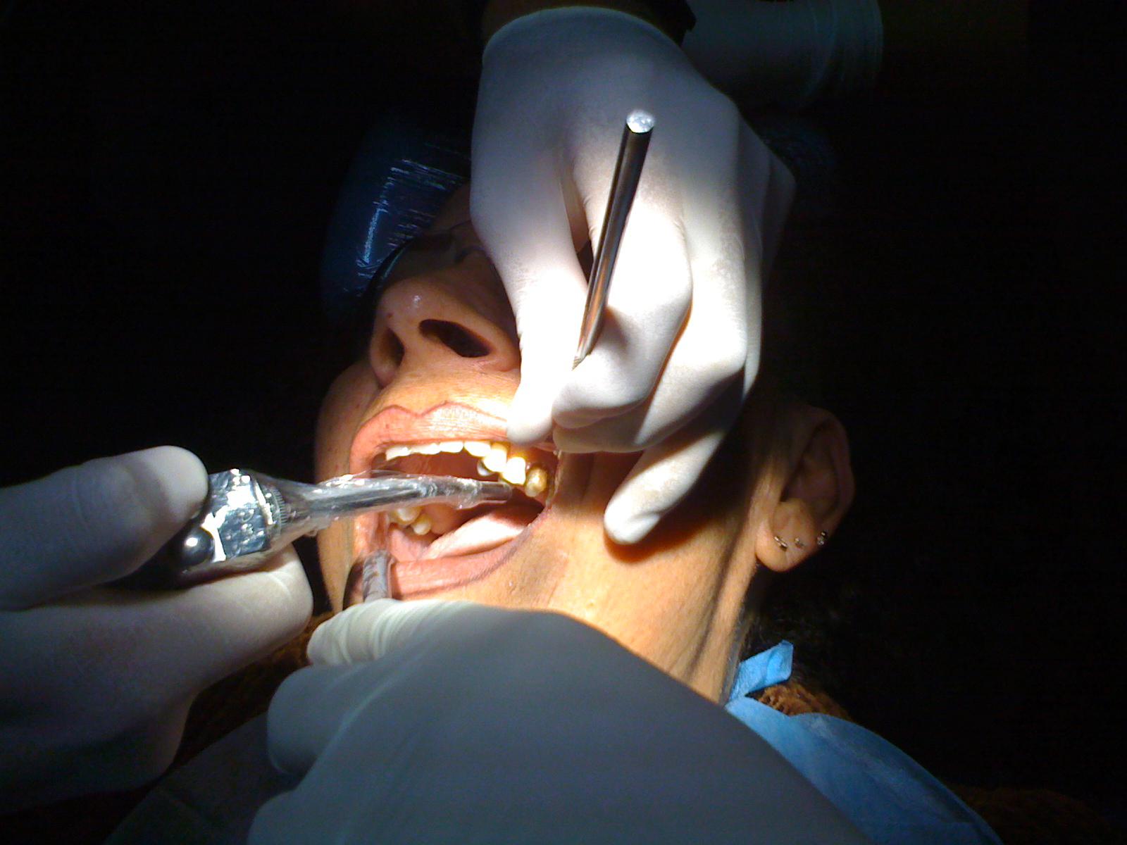 Estomatologia Mauricio Estrada: Paciente de Endodoncia en Clinica de Ceuni