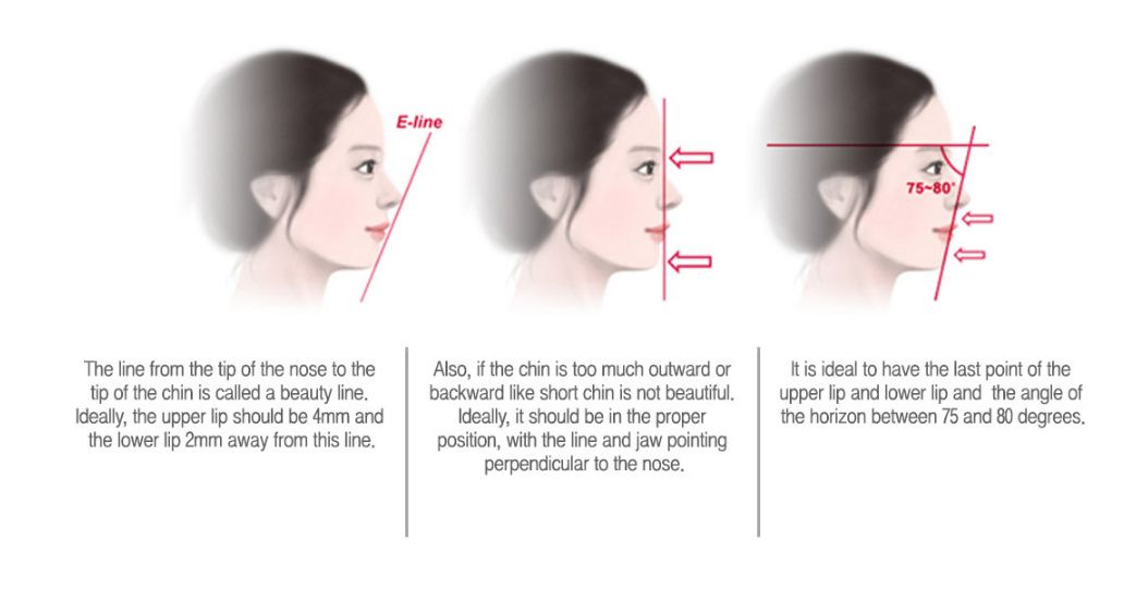 What is Faceline’s ASO (protruding mouth) Surgery?