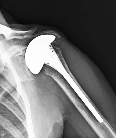 UW Shoulder and Elbow Academy: What's the difference between a reverse ...