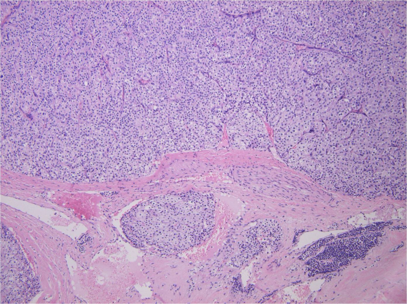 GO BIG or GO HOME: Parathyroid carcinoma