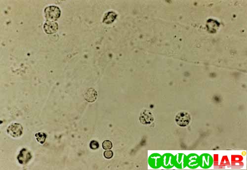 Atlas of Casts in urine | Free Medical Atlas