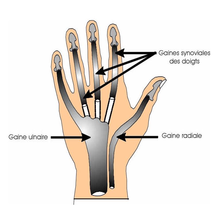 Un Jour En Chirurgie Orthopedique Et Traumatologique: Phlegmon de la ...