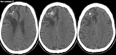 Brain Bleed: Brain Bleed Ct Scan