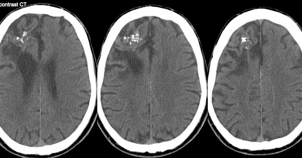 Neuroradiology Cases: Cavernoma with Bleed