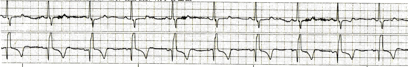 ECG Channel: Sinus Bradycardia