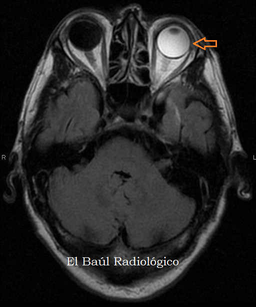 El Baúl Radiológico: ARTEFACTOS OCULARES PRODUCIDOS POR HETEROGENEIDAD ...