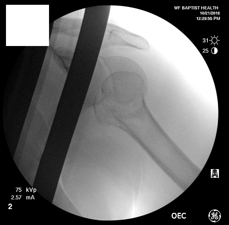 Shoulder and Elbow Surgery: Proximal humerus fracture dislocation. How ...