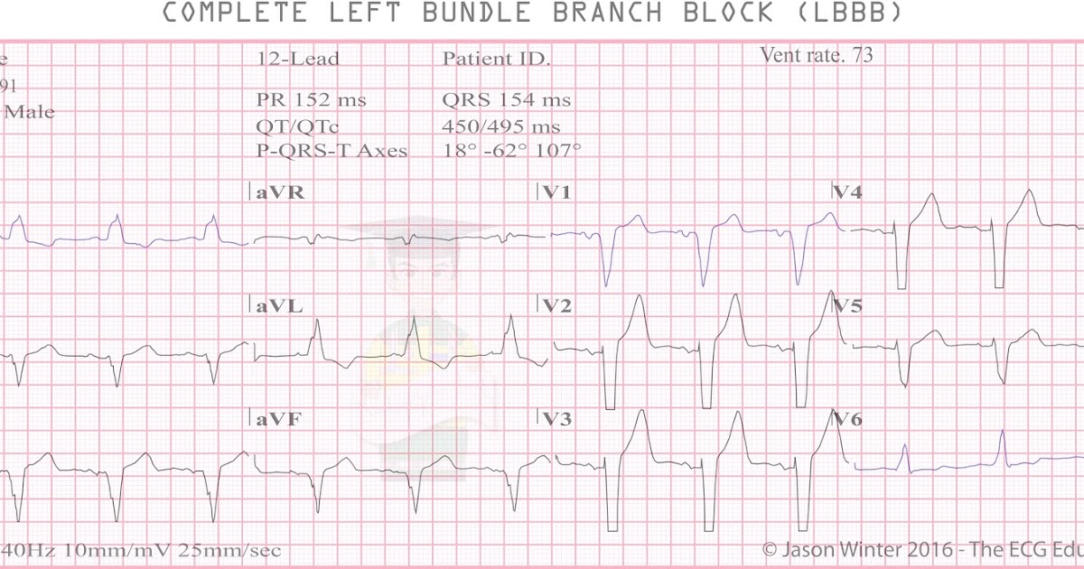 ECG Educator Blog : Bundle Branch Blocks