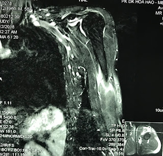 VIETNAMESE MEDIC ULTRASOUND: CASE 478: POPEYE’ SIGN of BICEPS MUSCLE ...