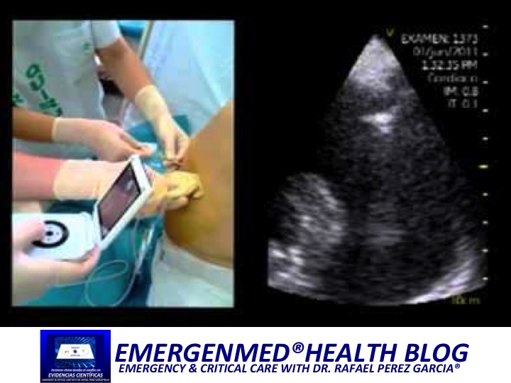 EmergenMed Health Blog: Toracocéntesis diagnóstica y terapéutica