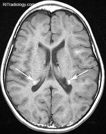 RiT radiology: Tuberous Sclerosis Complex