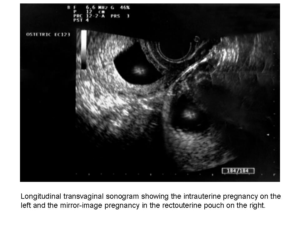 BÀI SOẠN VỀ SIÊU ÂM CHẨN ĐOÁN: MIRROR-IMAGE ARTIFACT on TVS