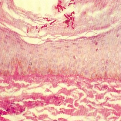 Micosis Humana: Tipos de Dermatomicosis