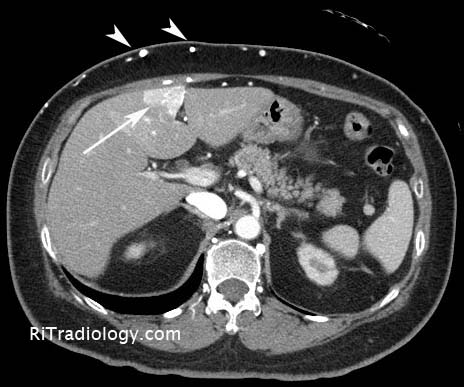 RiT radiology: Focal Hepatic Hot Spot Sign