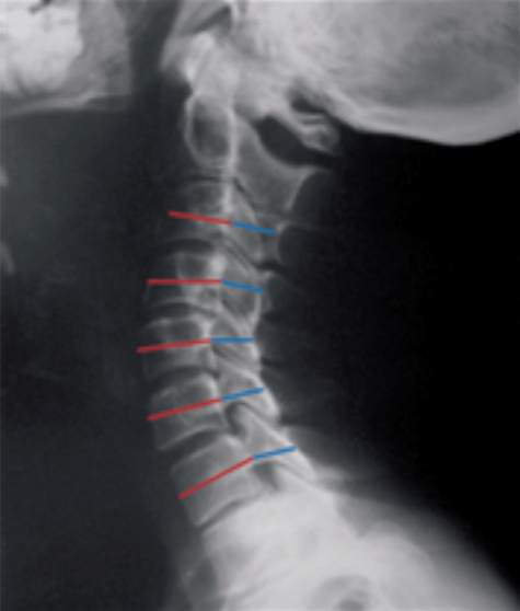Columna vertebral degenerativa