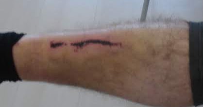 Contusiones simples y complejas