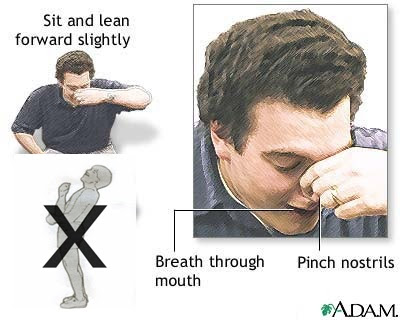 My Med Column: OMG Nose Bleed!