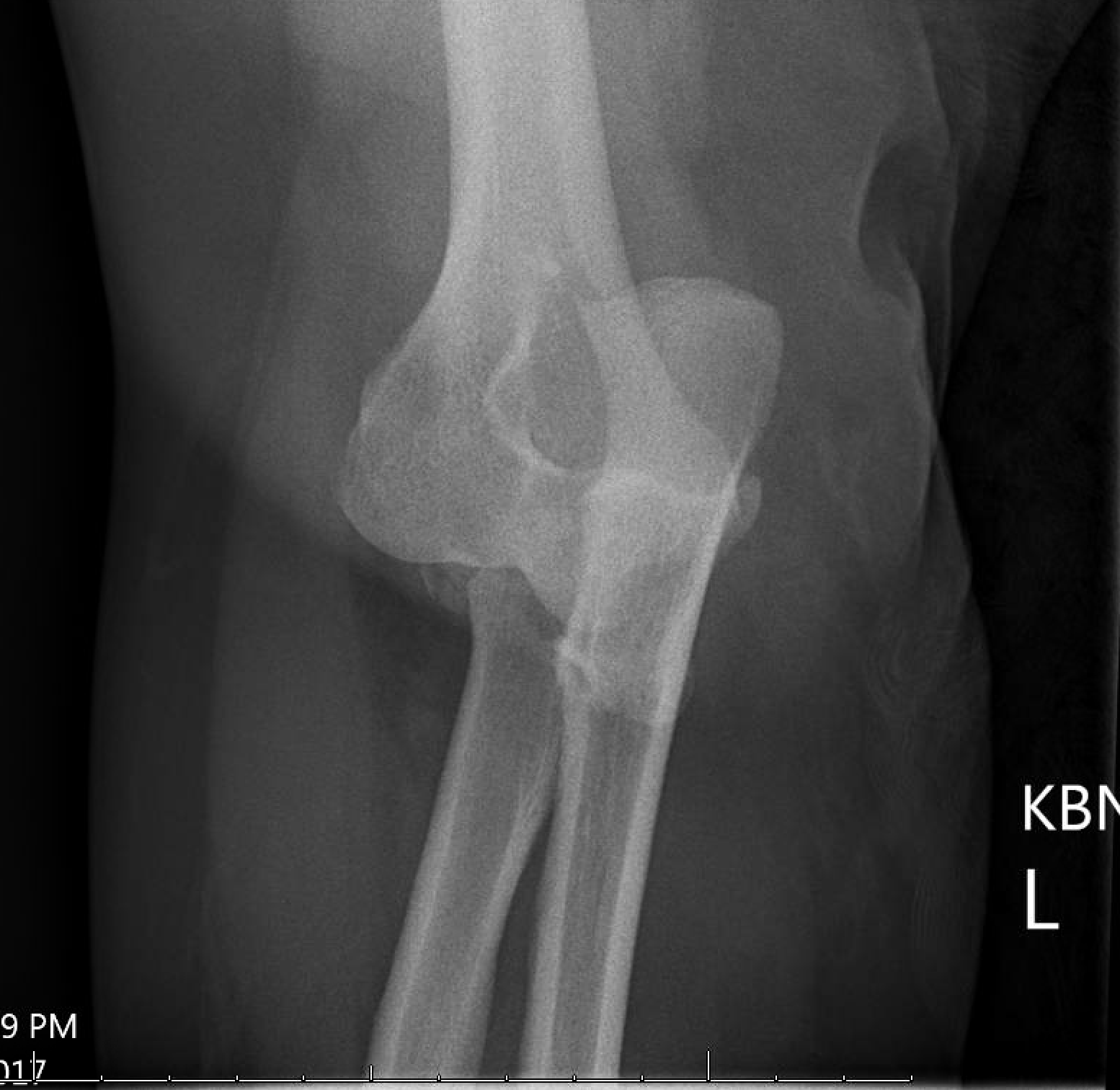 Shoulder and Elbow Surgery: Terrible triad injury. The importance of ...