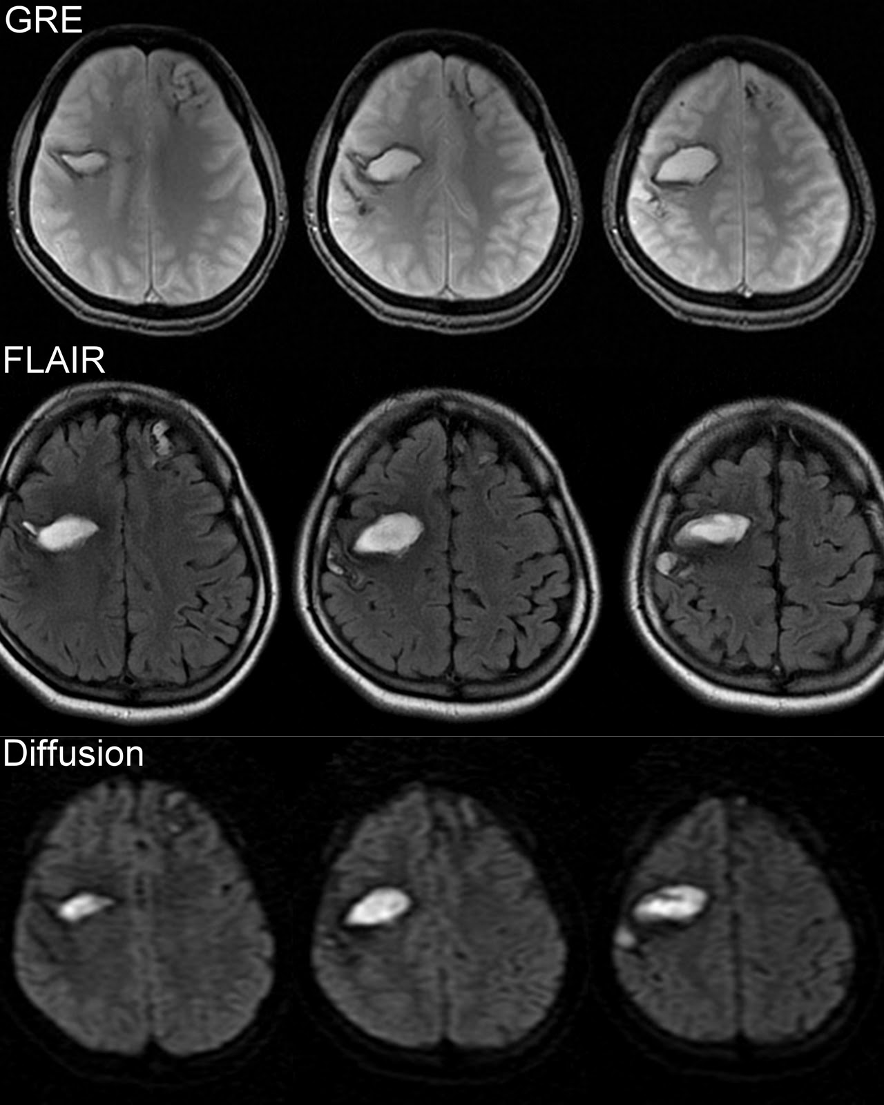 Dr Balaji Anvekar FRCR: Role of MRI Diffusion