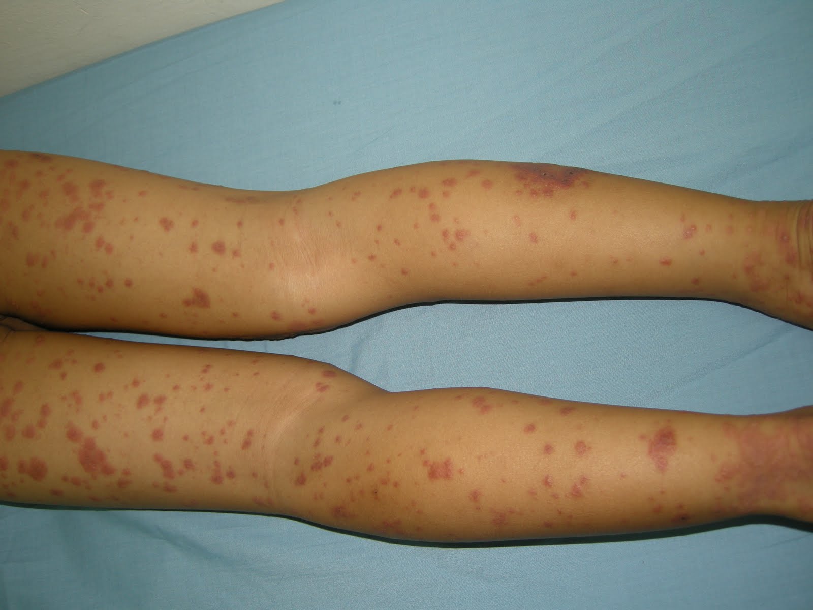 VIRTUAL GRAND ROUNDS IN DERMATOLOGY 2.0: Erythema multiforme major