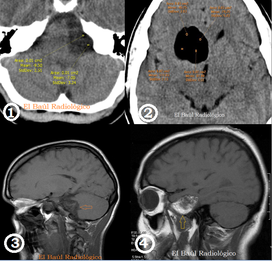 El Baúl Radiológico: 2) QUISTE DERMOIDE INTRACRANEAL (Intracranial ...