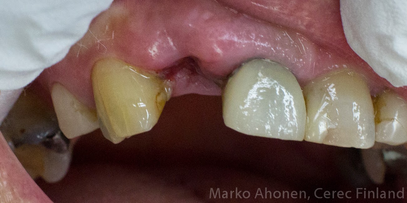 Cerec Finland: Väliaikainen kuitusilta poistetun hampaan tilalle ...