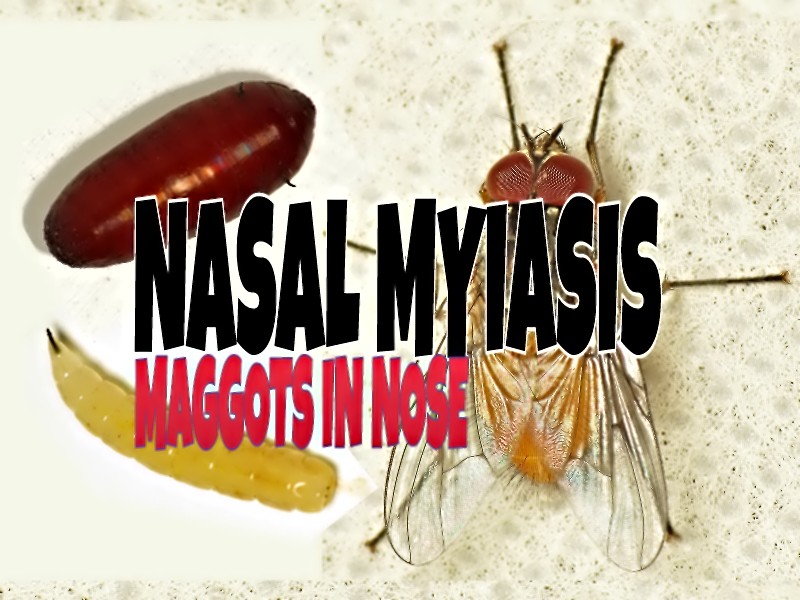 Nasal Myiasis