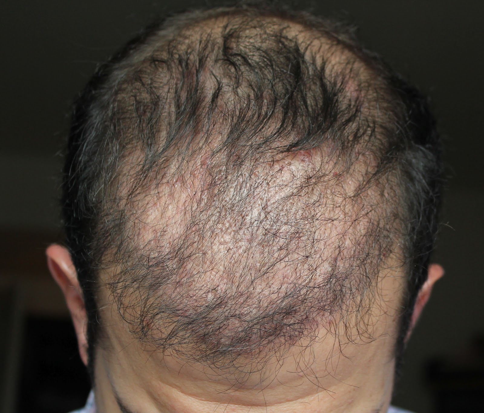 Armani HairTransplant