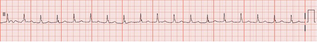 EKG Rhythm Strips 14: Junctional Rhythms