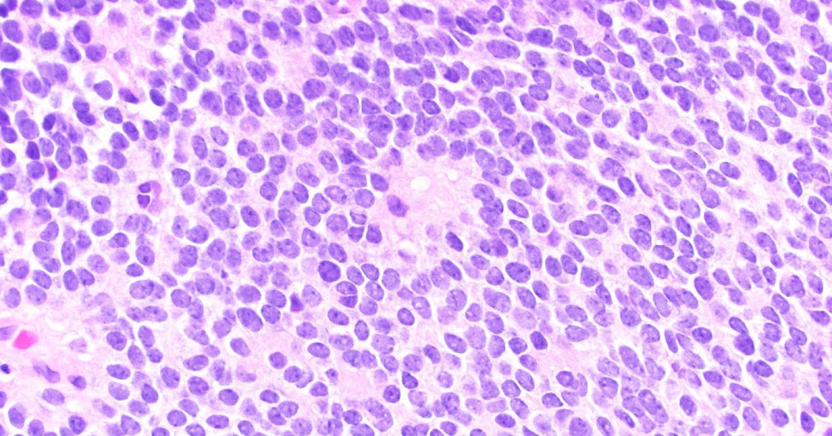 neuropathology blog: Pineal Parenchymal Tumor of Intermediate ...