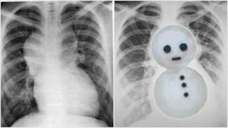 Chest Medicine Made Easy-Dr Deepu: Classical X Ray Signs in congenital ...