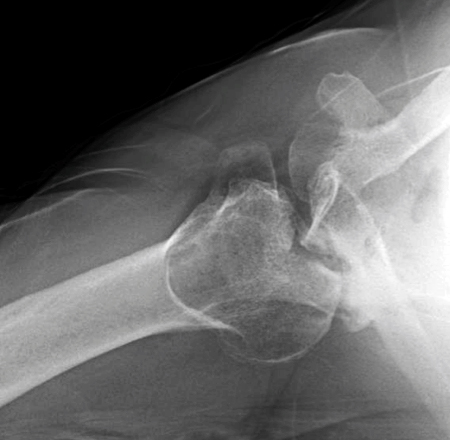 Shoulder Arthritis / Joint Replacement : A difficult combination ...