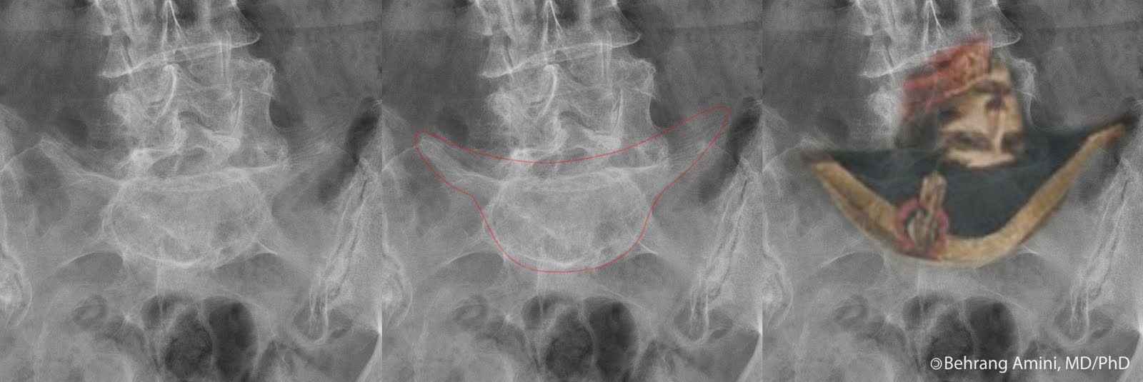 Roentgen Ray Reader: Inverted Napoleon's Hat Sign