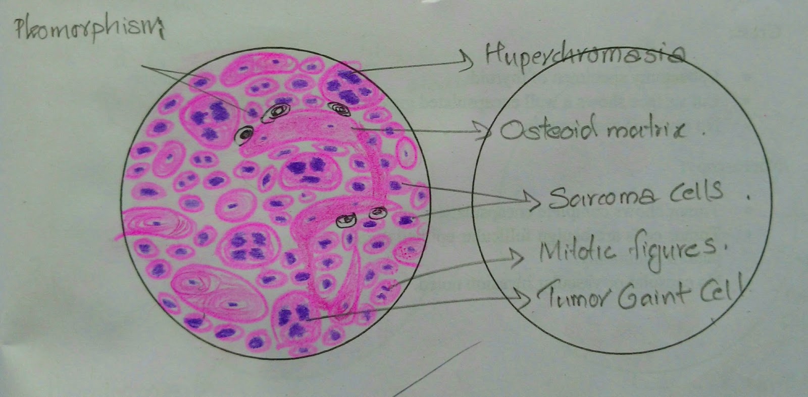 Histopathology Drawings: Osteosarcoma