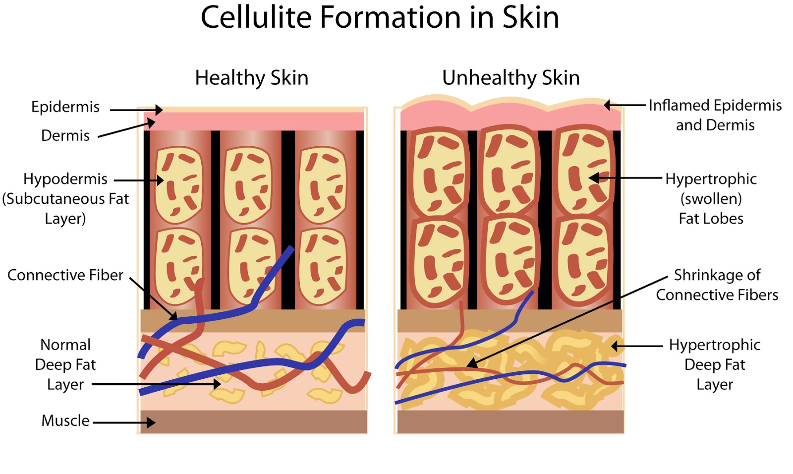 Can You Remove Cellulite? | Learn About Women's Health - Medical ...