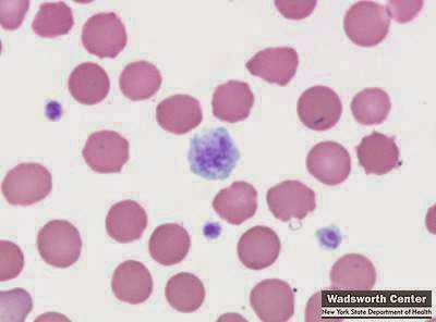 Fichero de Hematología : MORFOLOGÍA ANORMAL DE CÉLULAS SANGUÍNEAS ...